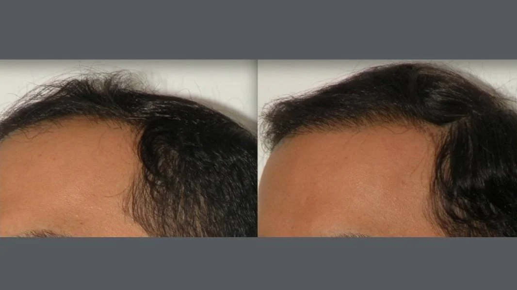 NeoGraft® Hair Transplant Restoration — Opulence Chicago | Med Spa