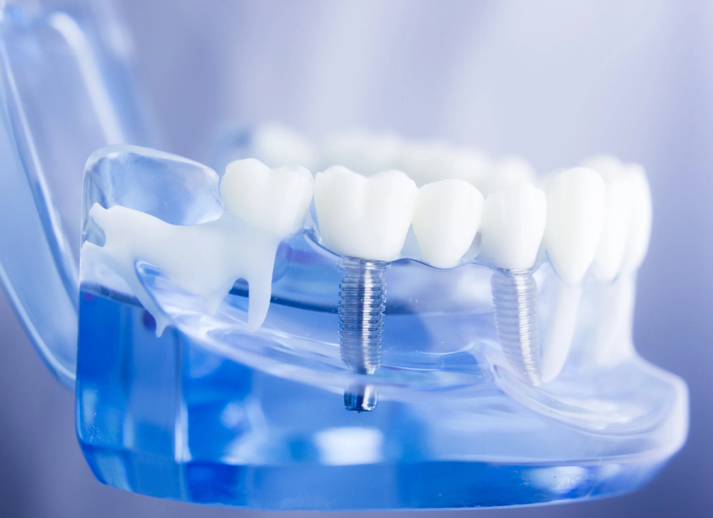 Periodontics & Dental Implants in Bedford, TX | George D. Pylant III, DDS