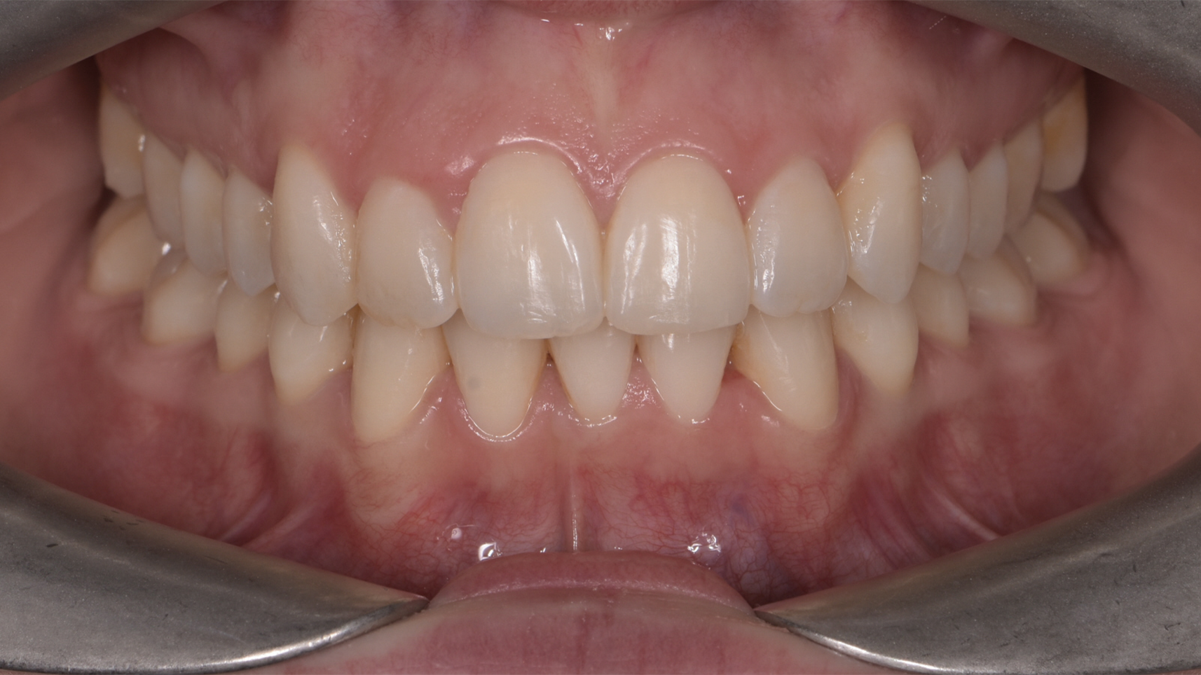 Lower Incisor Extraction Case — e-LINE Orthodontics Lower Incisor Extraction Case — e-LINE Orthodontics