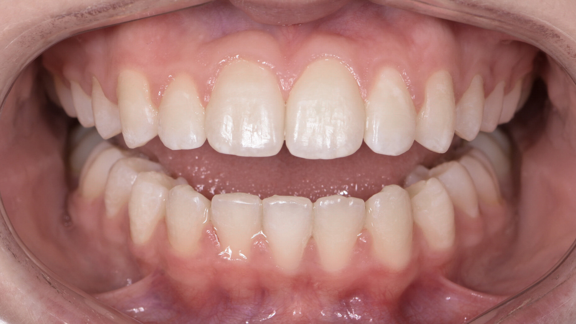 Lower Incisor Extraction: An Alternative Approach — e-LINE Orthodontics Lower Incisor Extraction: An Alternative Approach — e-LINE Orthodontics