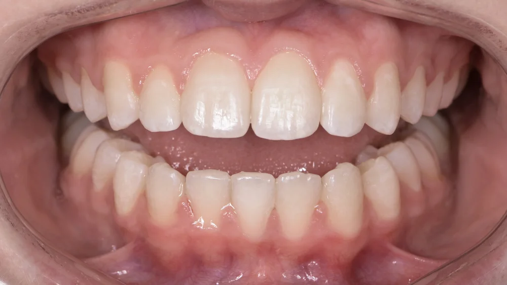 Lower Incisor Extraction: An Alternative Approach — e-LINE Orthodontics