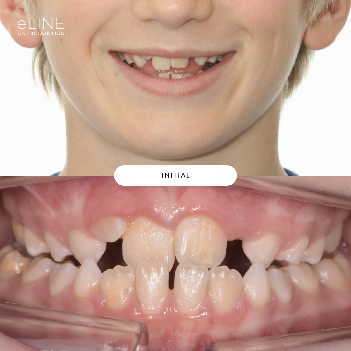 Early Orthodontics: Part 1 — e-LINE Orthodontics