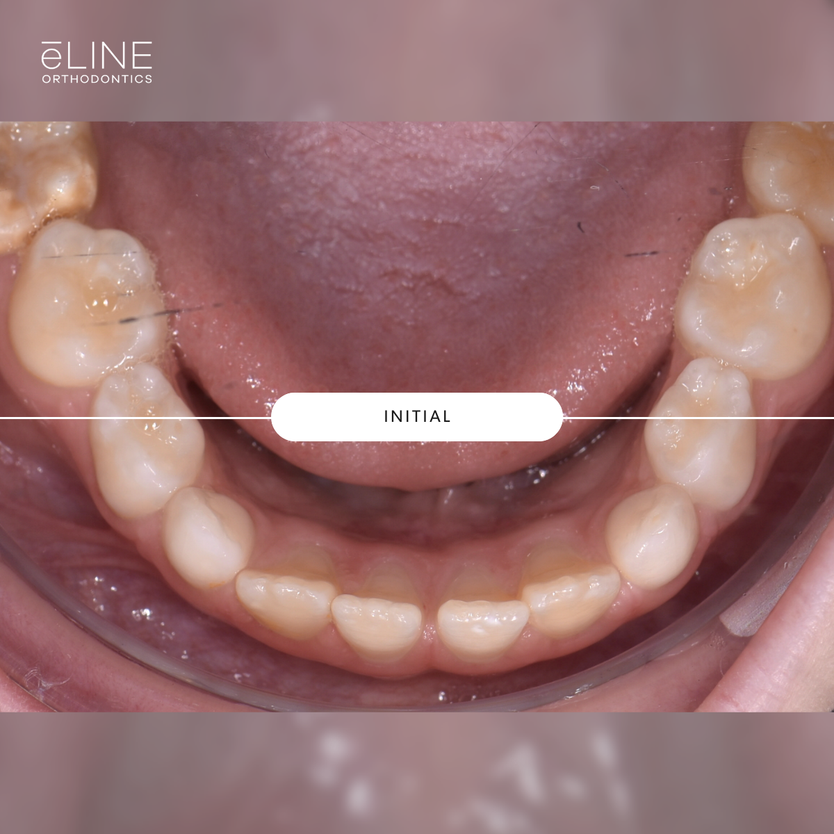 Early Orthodontics: Part 1 — e-LINE Orthodontics