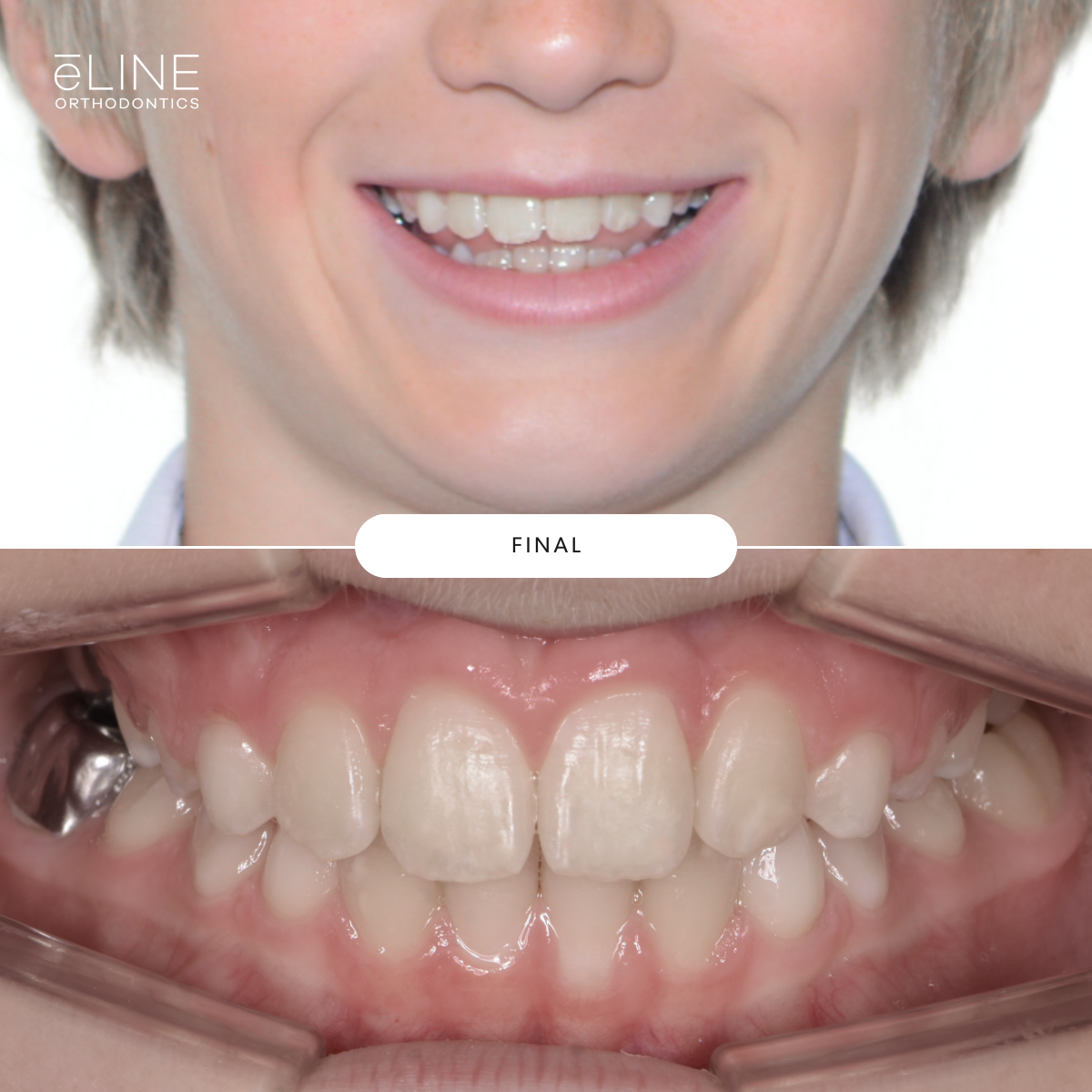 Early Orthodontics: Part 1 — e-LINE Orthodontics