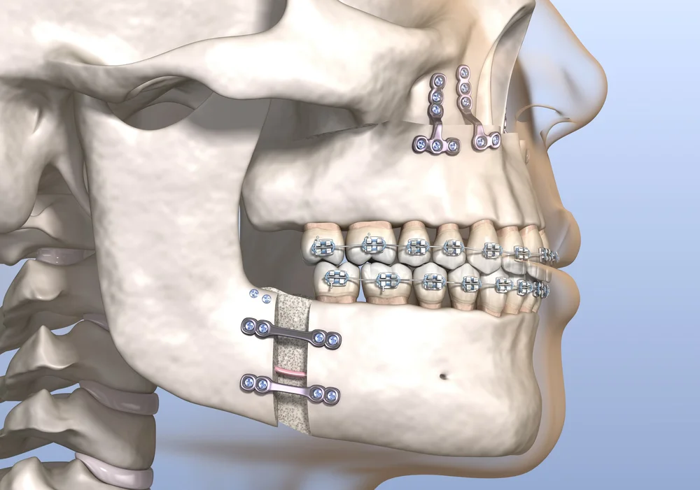 In Depth: What is Orthognathic Surgery and Would You Benefit From it ...