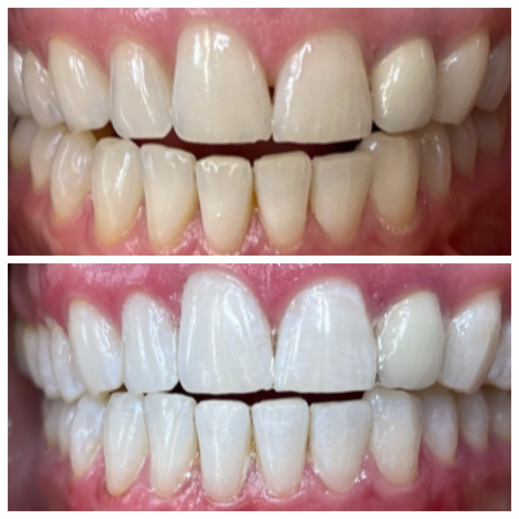 White Gums After Whitening