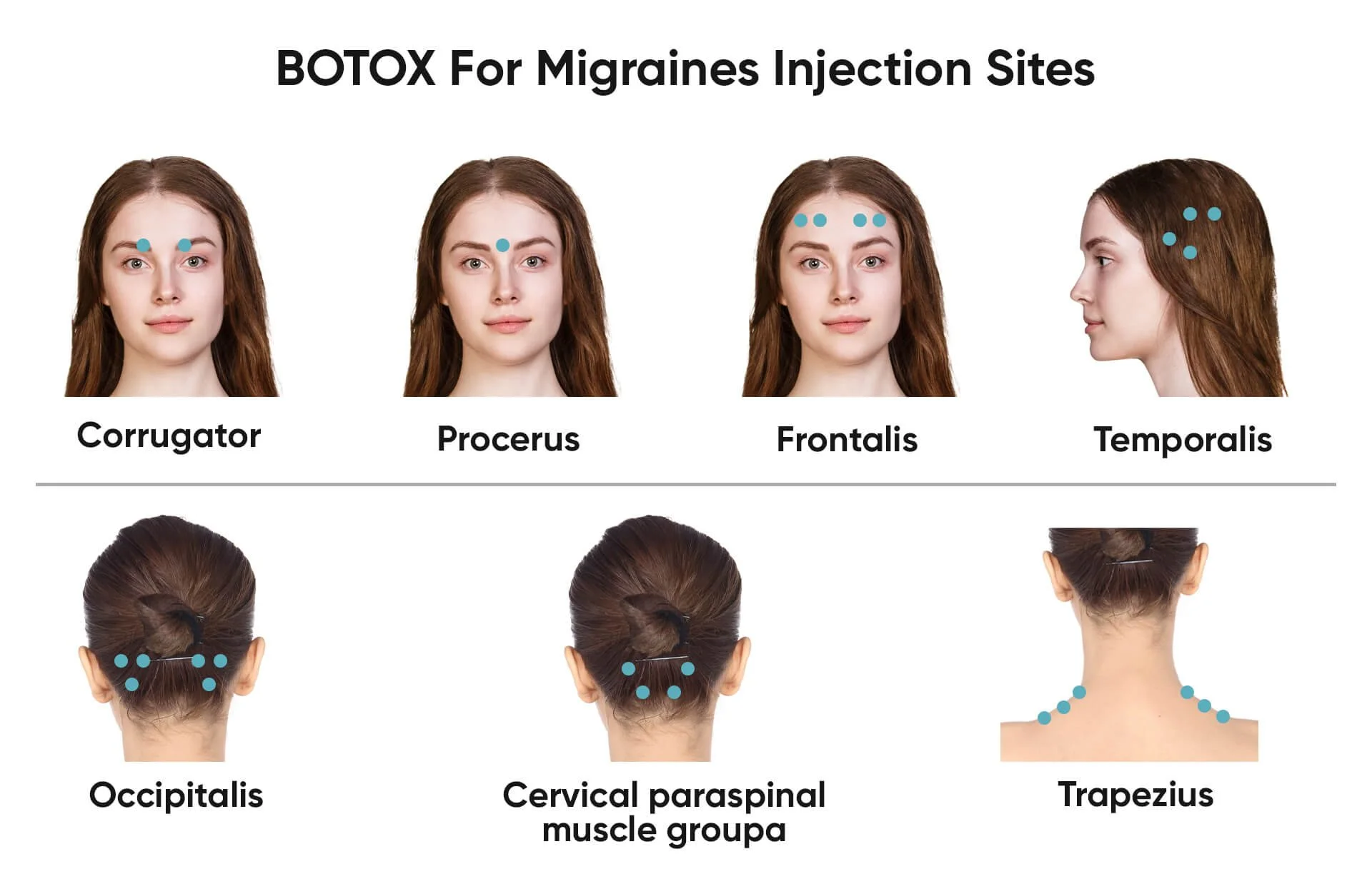 I Got Botox For Migraines By Mandy Maltz