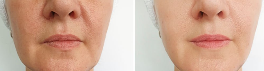 What is DAO Botox? — Graceful Skin Solutions