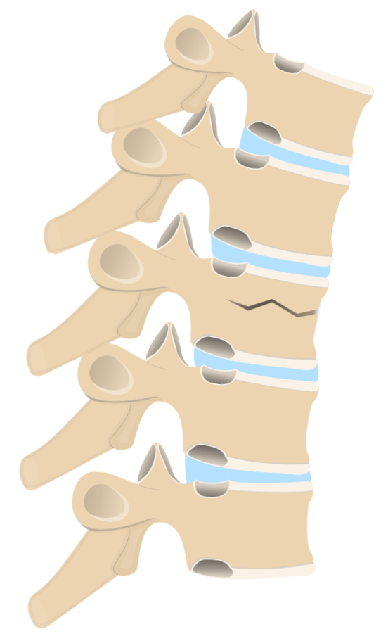 Compression Fractures — Physiotherapy London Ontario