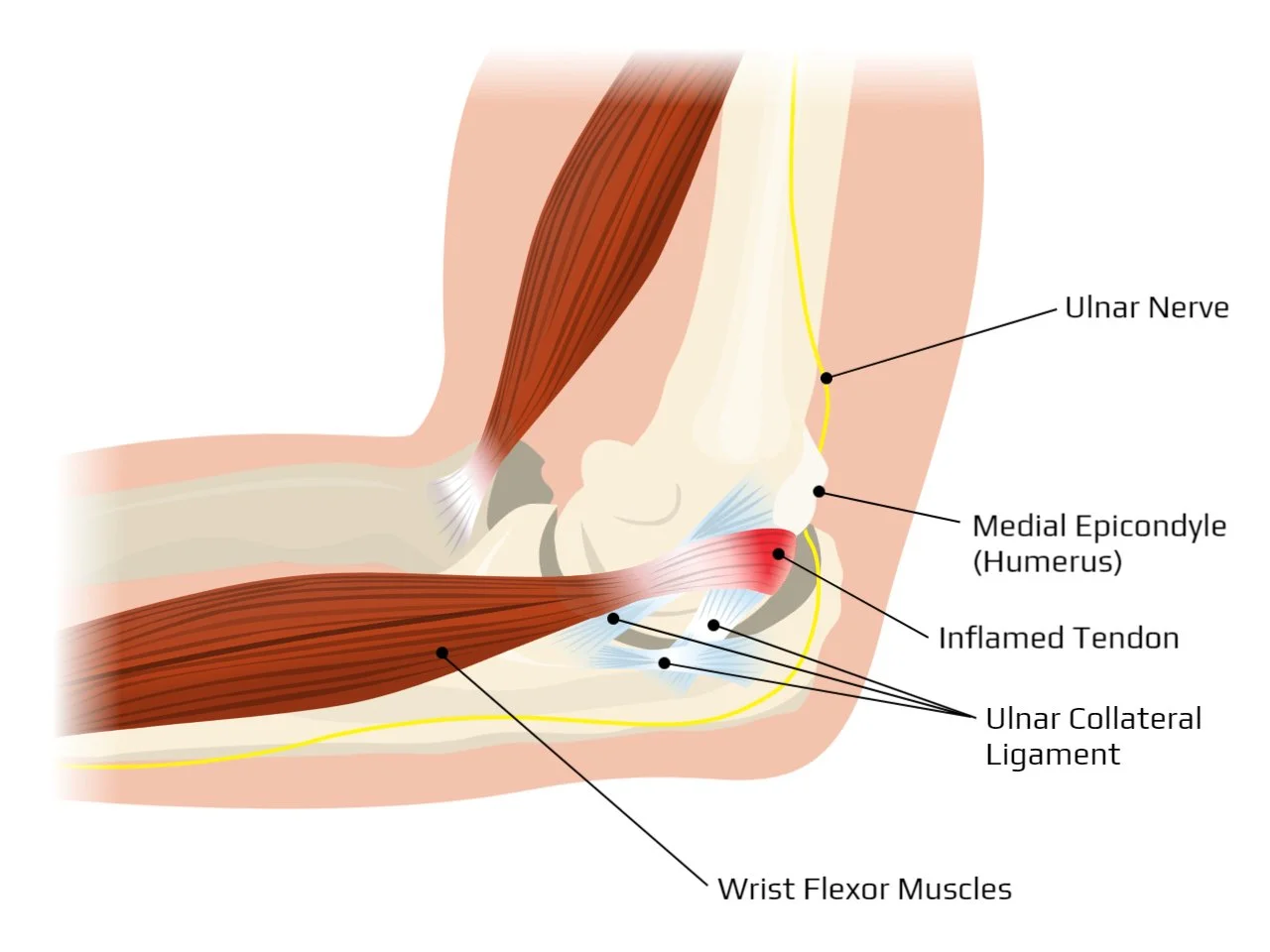 Pain on the inside of your elbow — Physiotherapy London Ontario