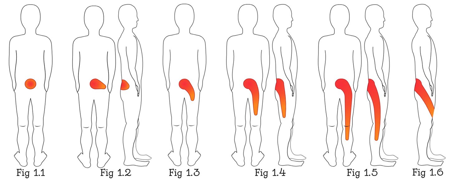 Centralization + Peripheralization — Physiotherapy London Ontario