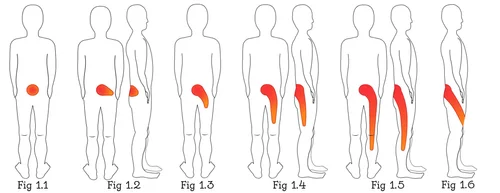 Centralization + Peripheralization — Physiotherapy London Ontario