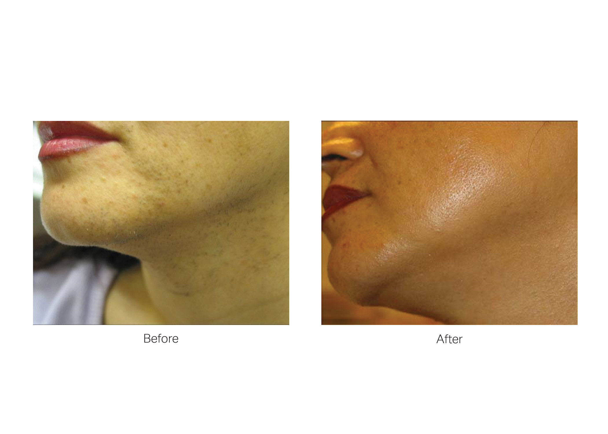 LipoMax Sculpt aesthetic body device — Estetique English