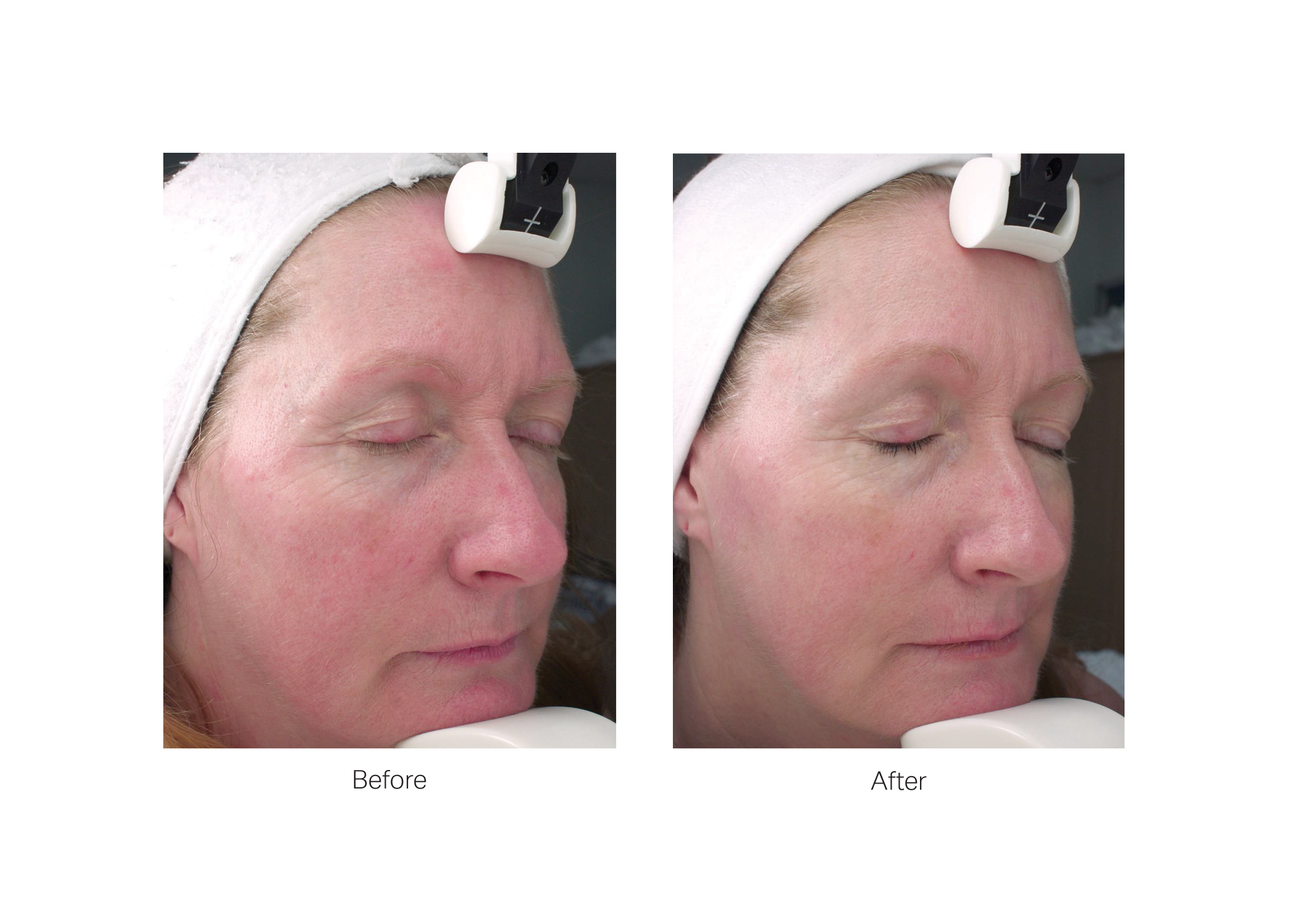 LumiMax photobiomodulation aesthetic device — Estetique USA