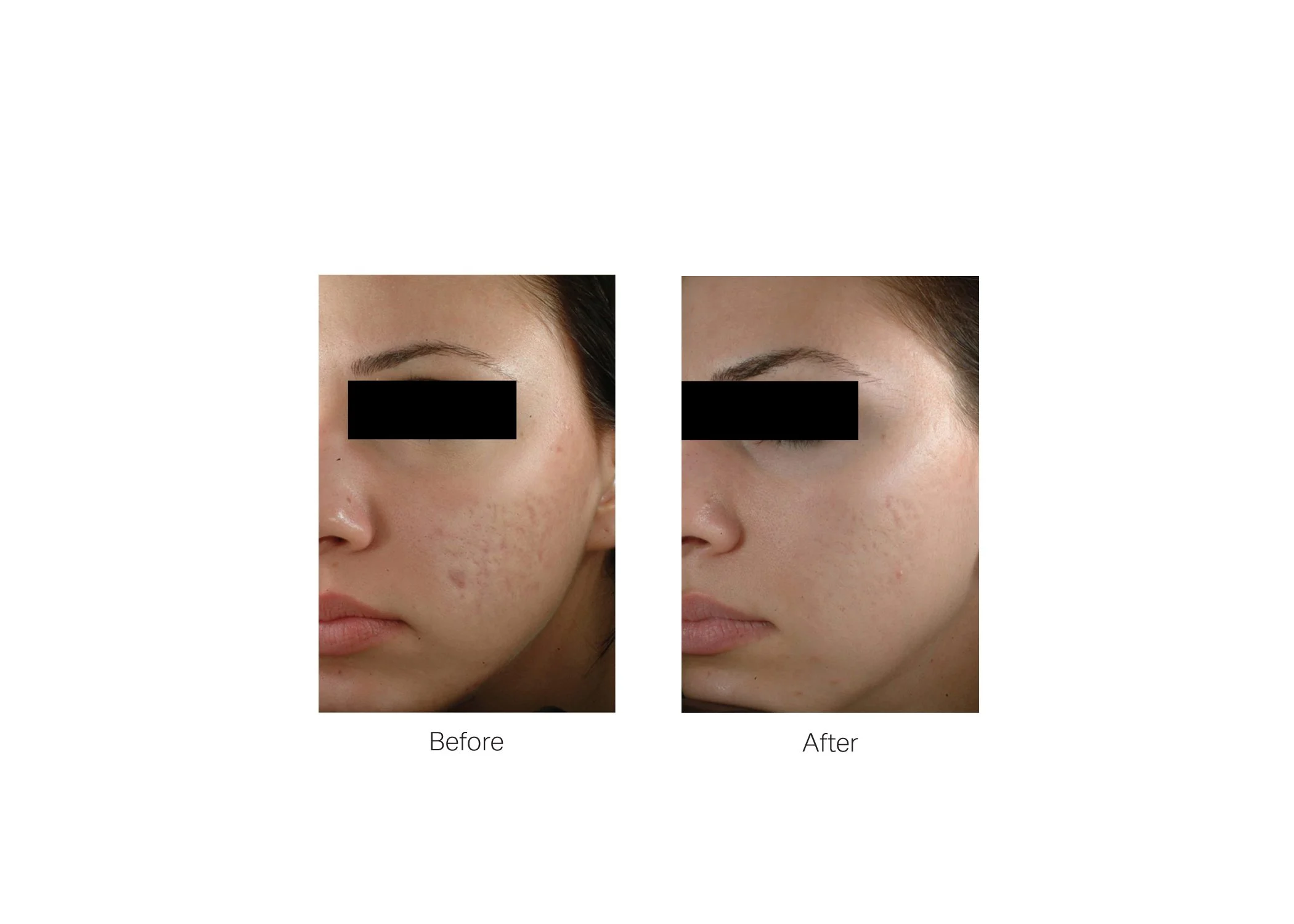 DermaMax RF Microneedling | Professional Spa Equipment — Estetique USA