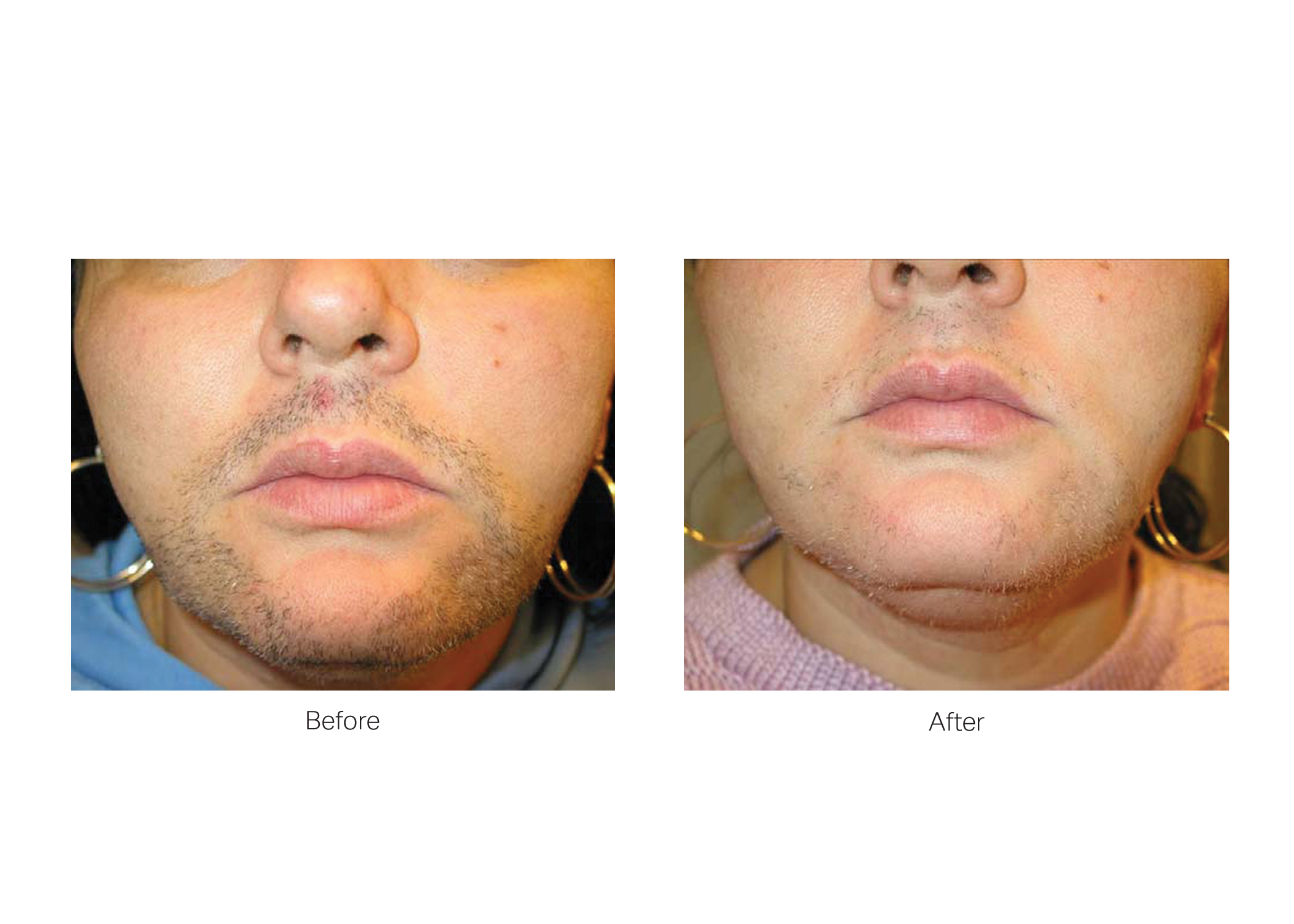 LipoMax Sculpt aesthetic body device — Estetique English