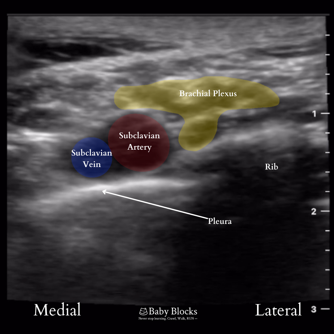 Supraclavicular Brachial Plexus Block — BABY BLOCKS