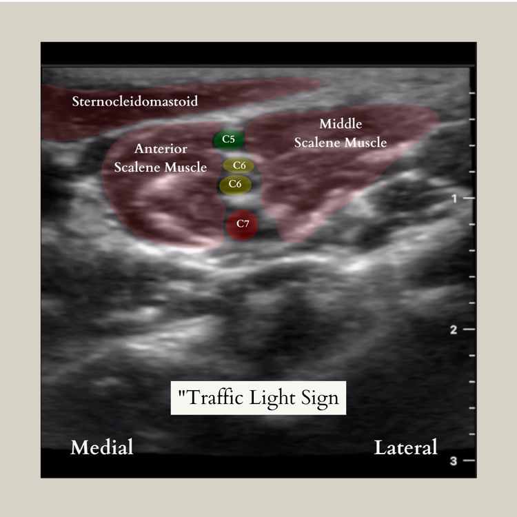 Interscalene Brachial Plexus Block — BABY BLOCKS