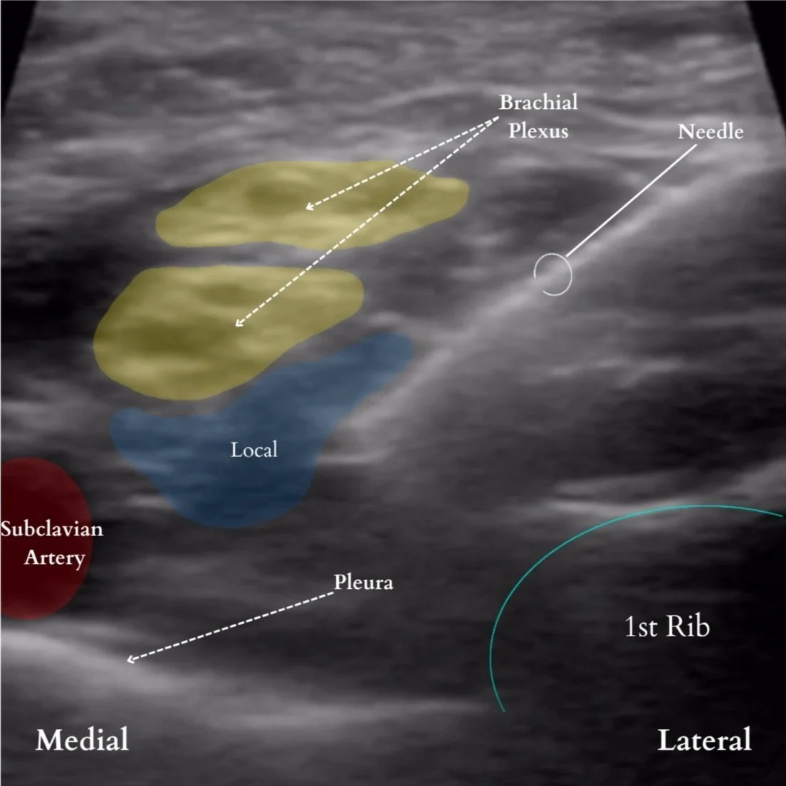 Supraclavicular Brachial Plexus Block — BABY BLOCKS