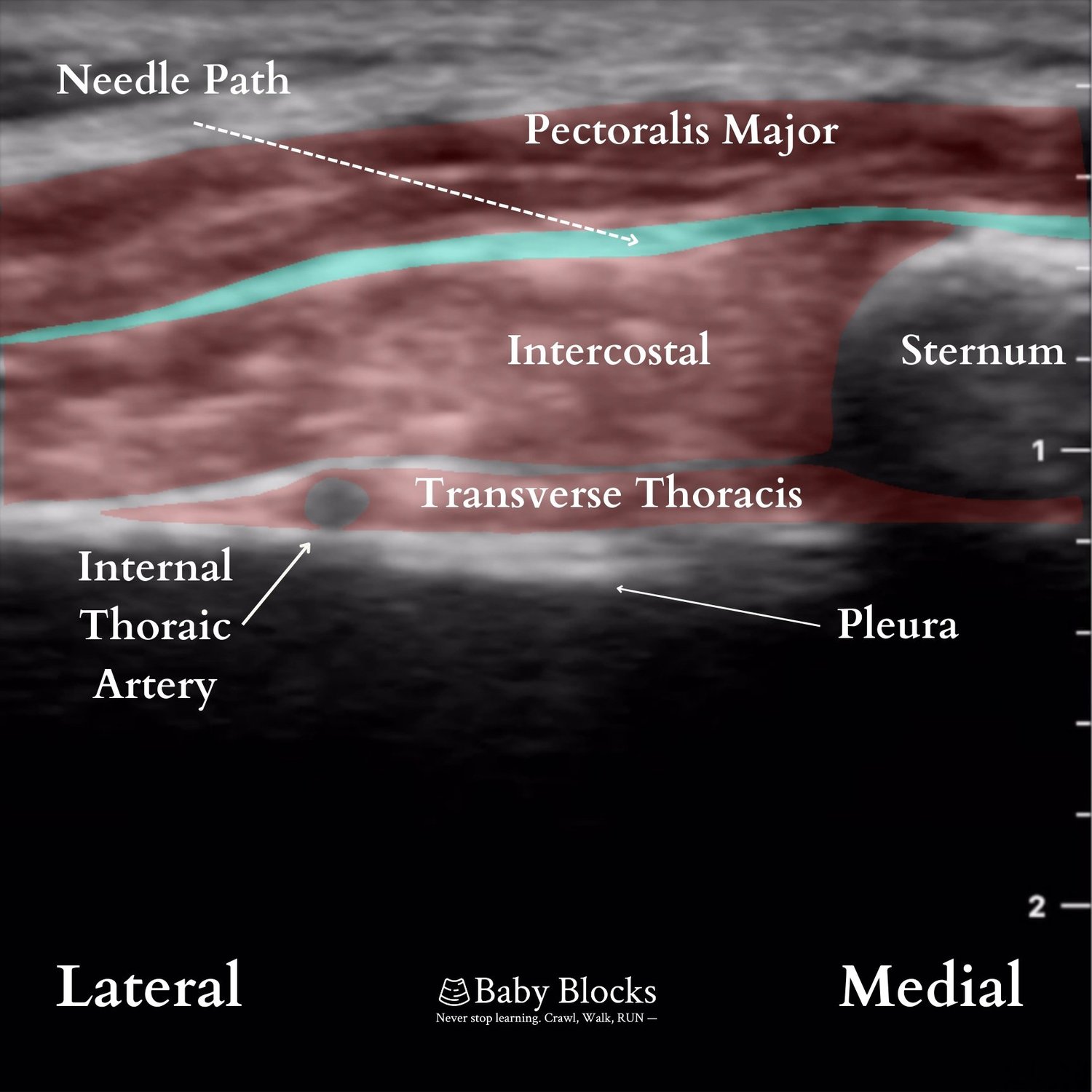 Superficial Parasternal Intercostal Plane Block — BABY BLOCKS
