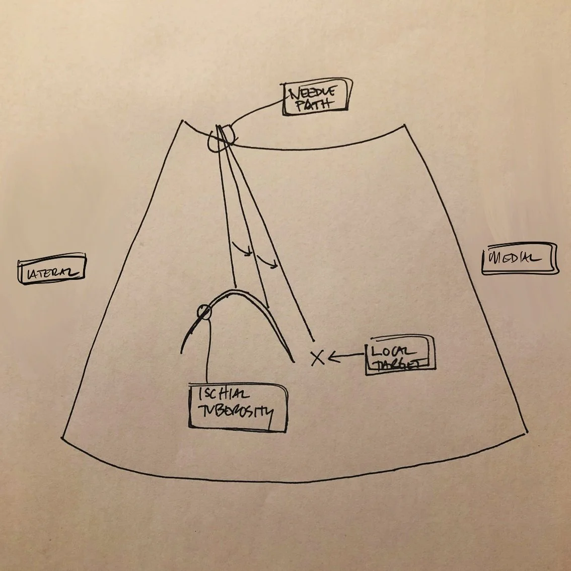 Pudendal Nerve Block — BABY BLOCKS
