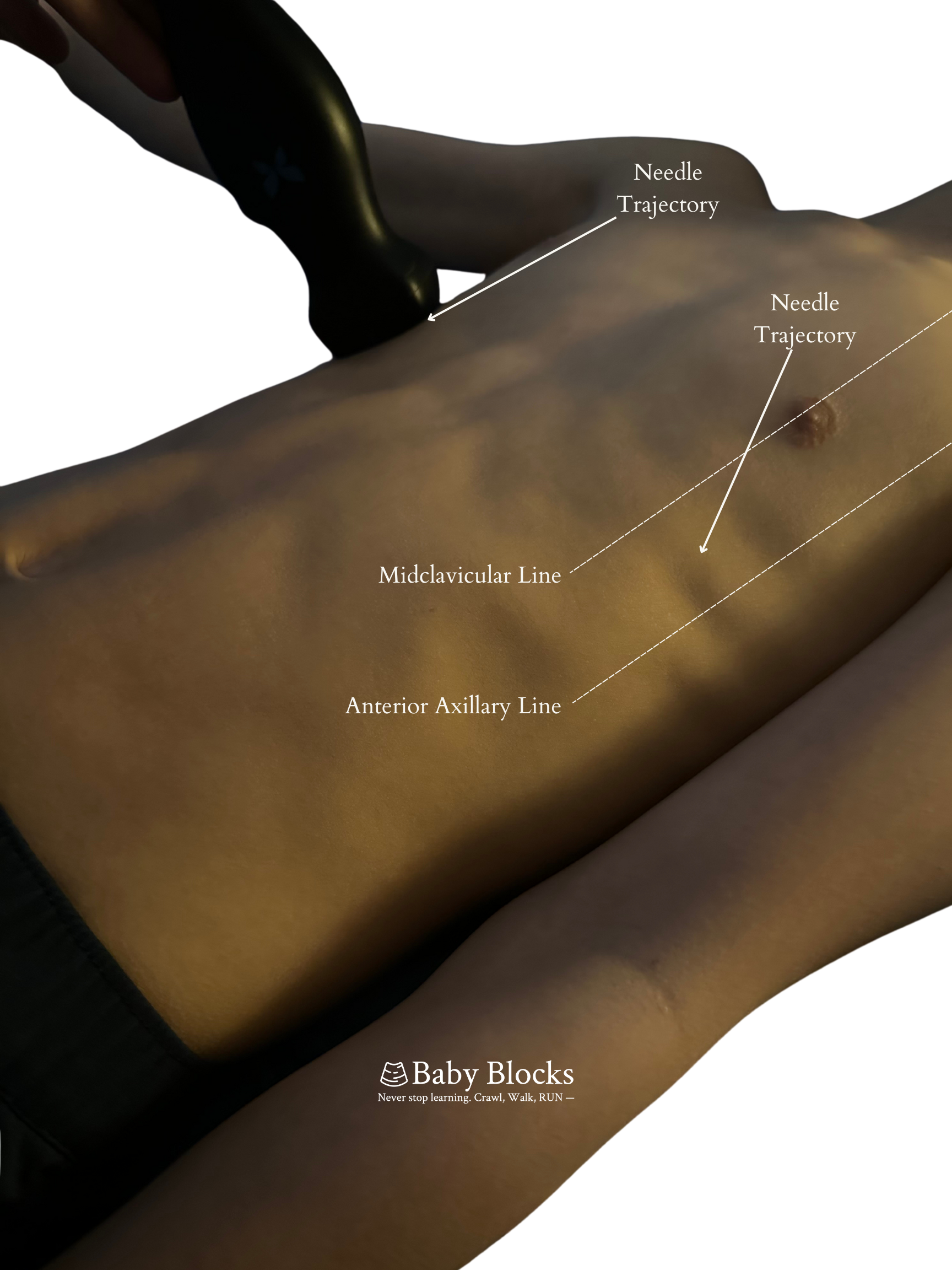 Ultrasound-Guided Pediatric External Oblique Intercostal Plane Block ...
