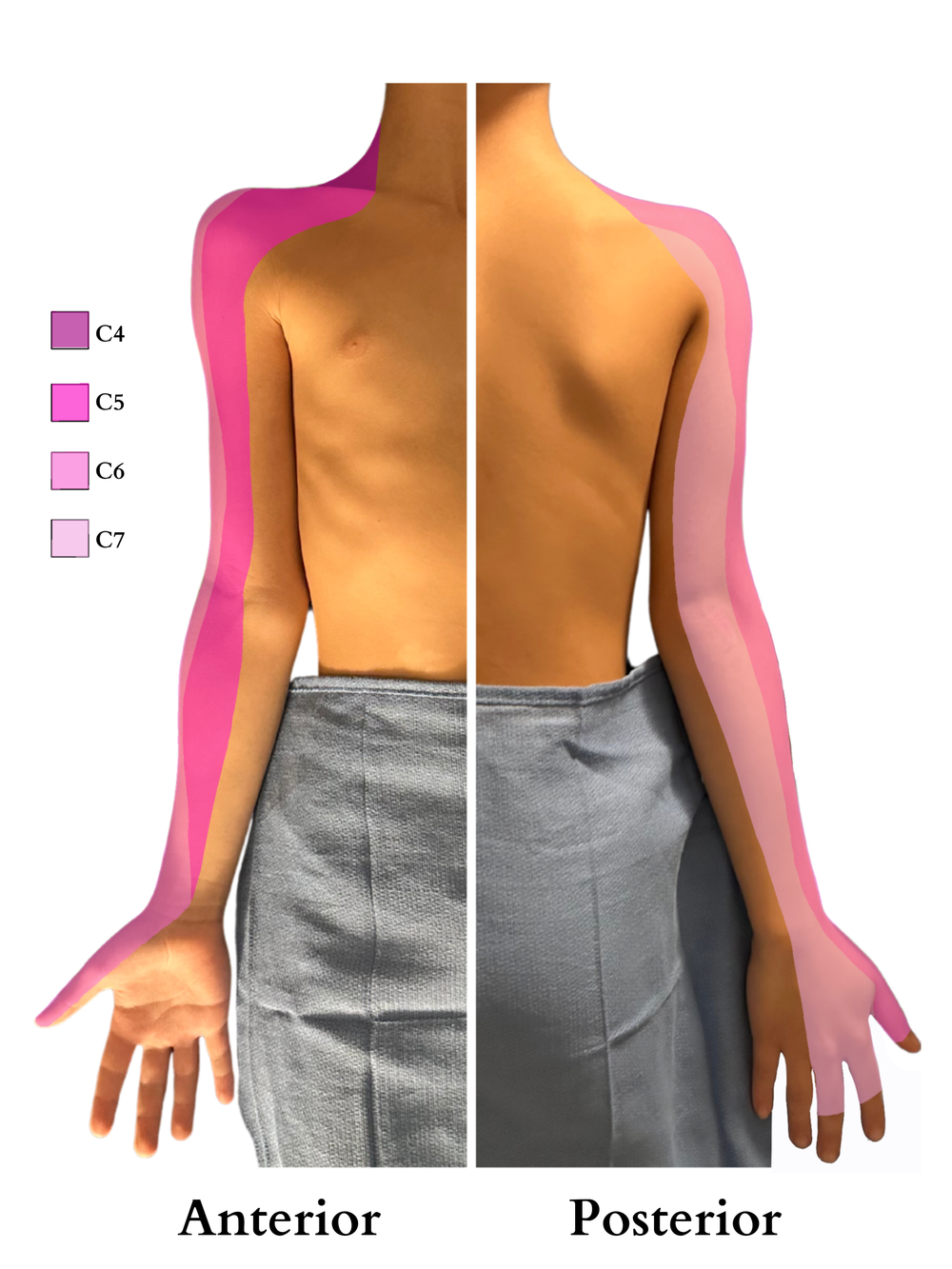 Interscalene Brachial Plexus Block — BABY BLOCKS