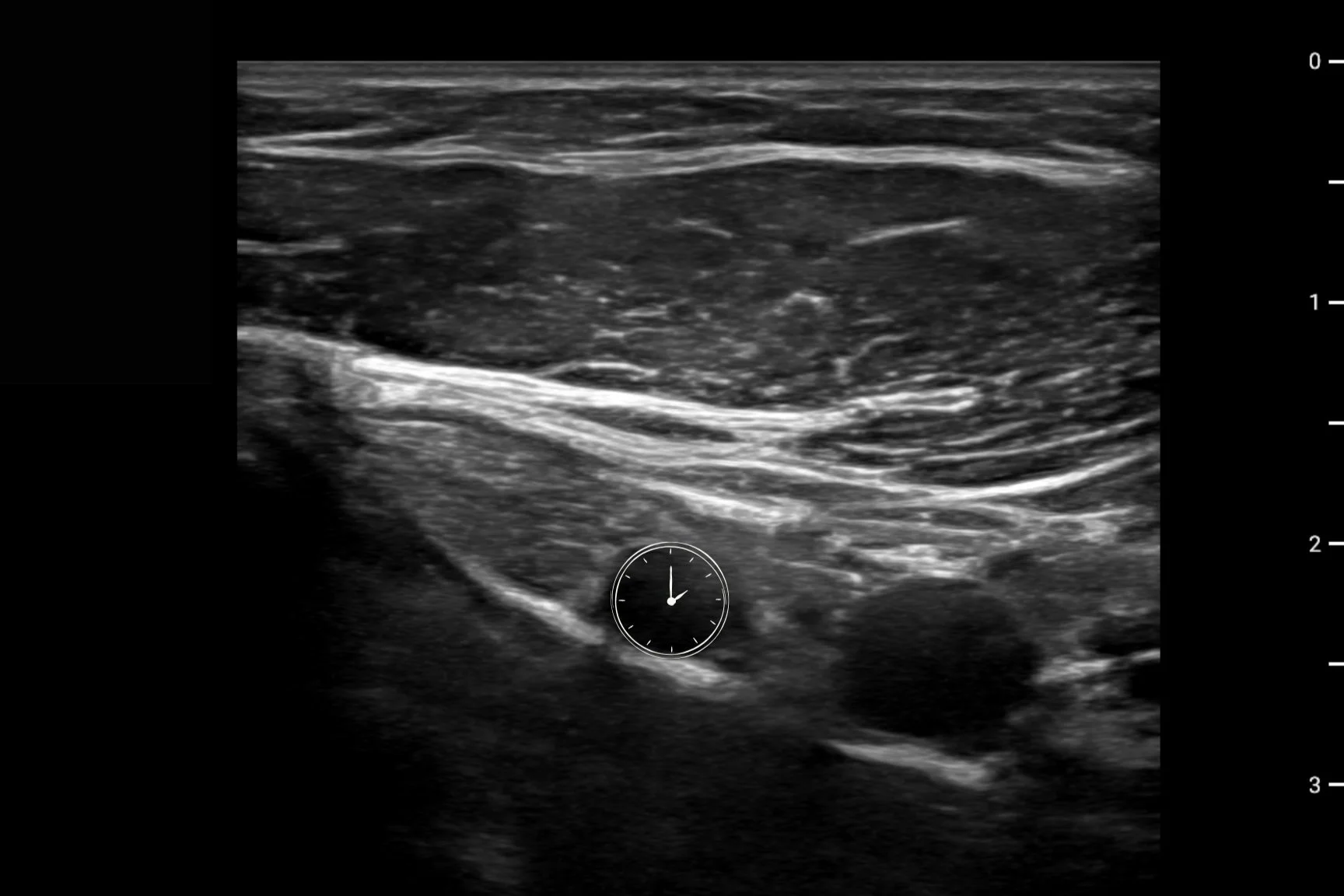Infraclavicular Brachial Plexus Block — BABY BLOCKS