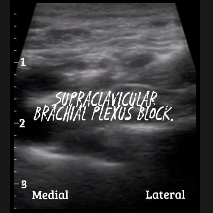 Supraclavicular Brachial Plexus Block — BABY BLOCKS
