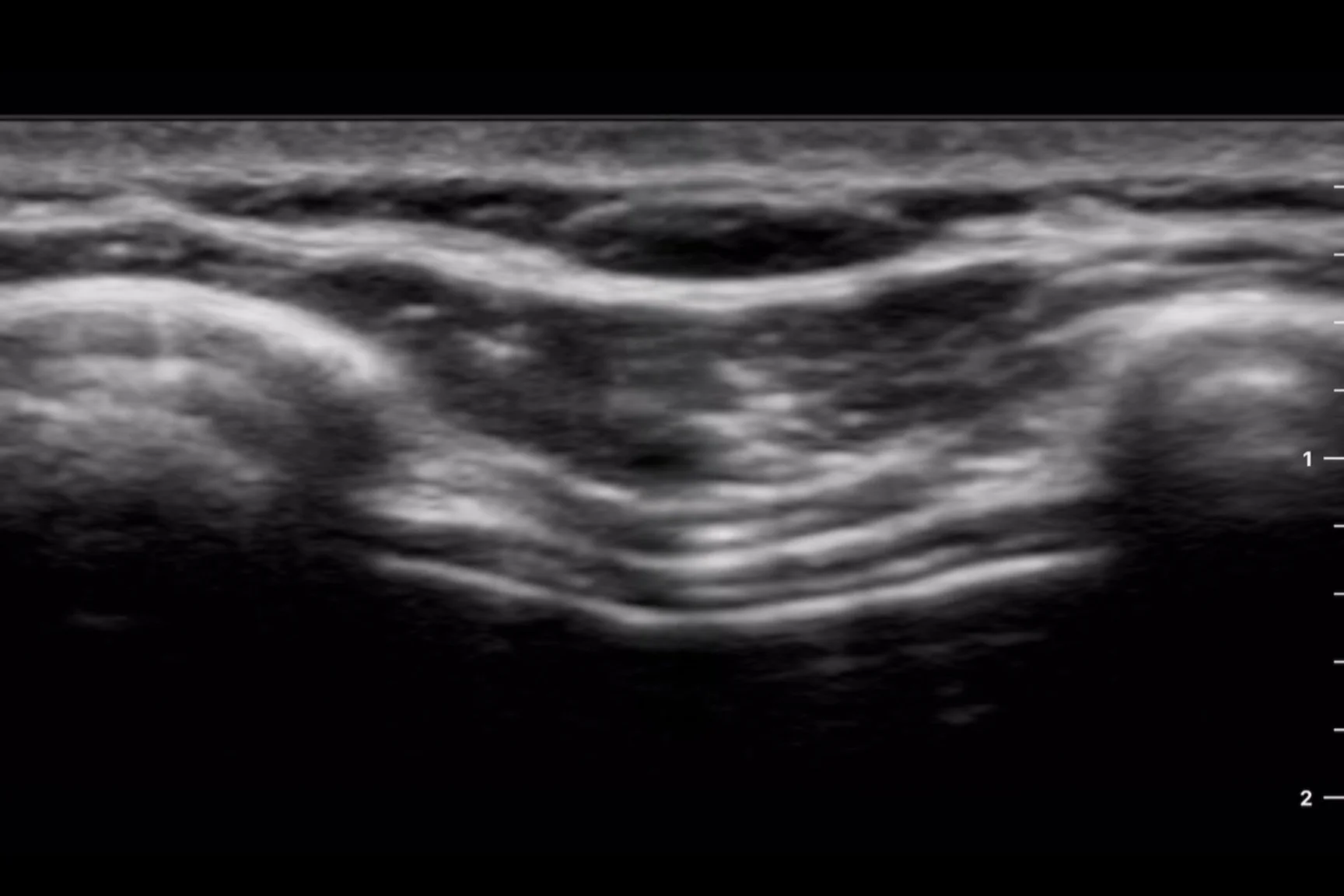 Ultrasound-Guided Pediatric External Oblique Intercostal Plane Block ...