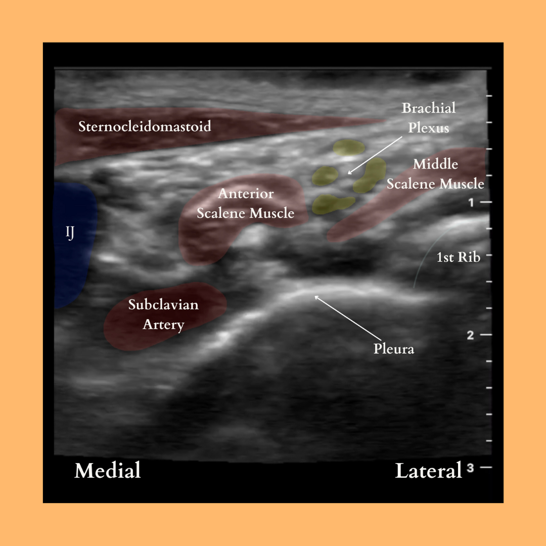 Interscalene Brachial Plexus Block — BABY BLOCKS
