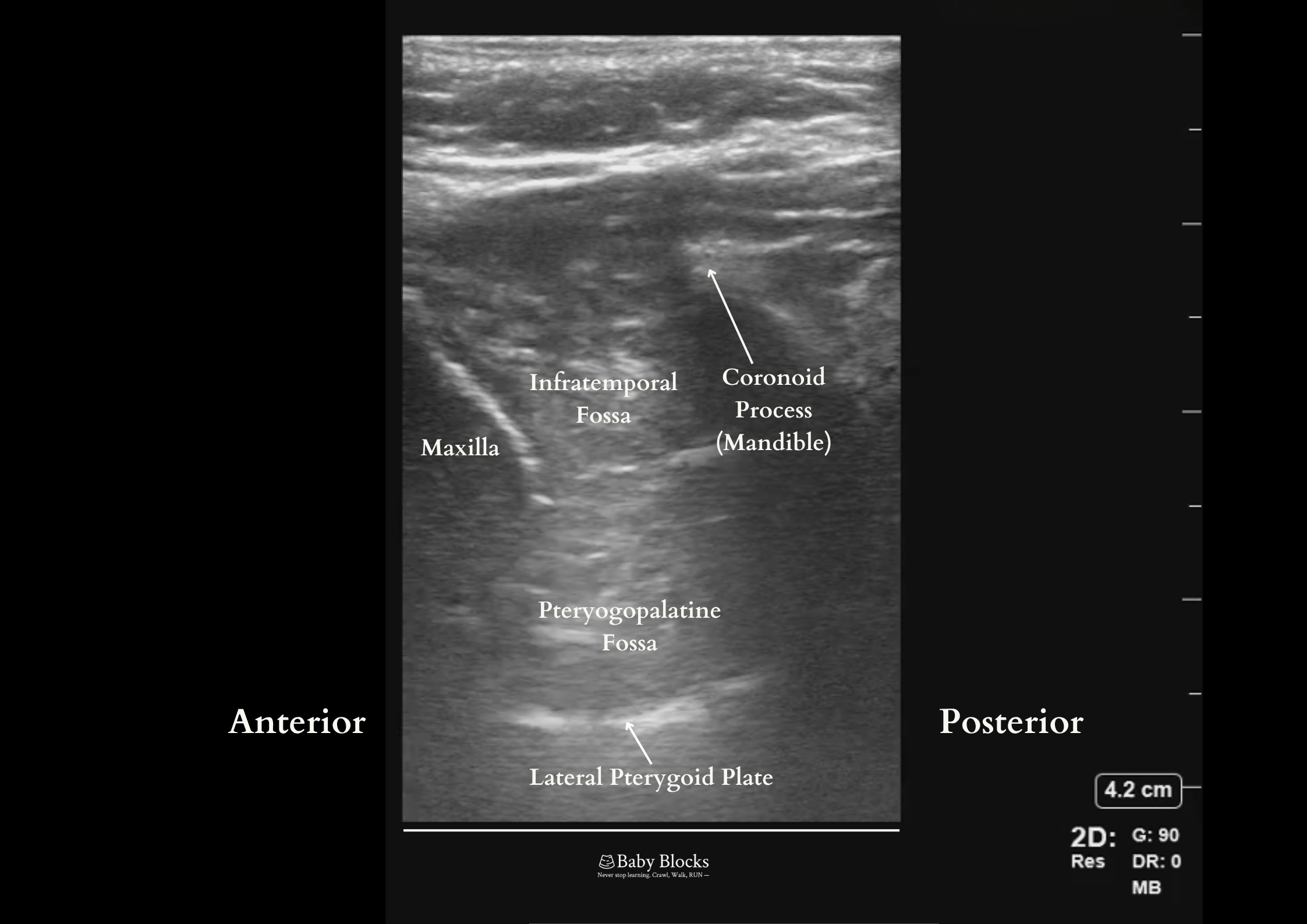 Suprazygomatic Maxillary Nerve Block — BABY BLOCKS
