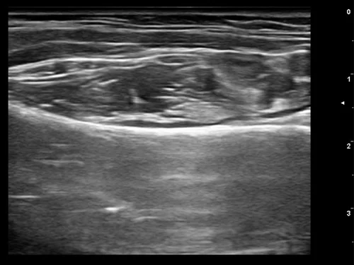 PEricapsular Nerve Group (PENG) Block — BABY BLOCKS