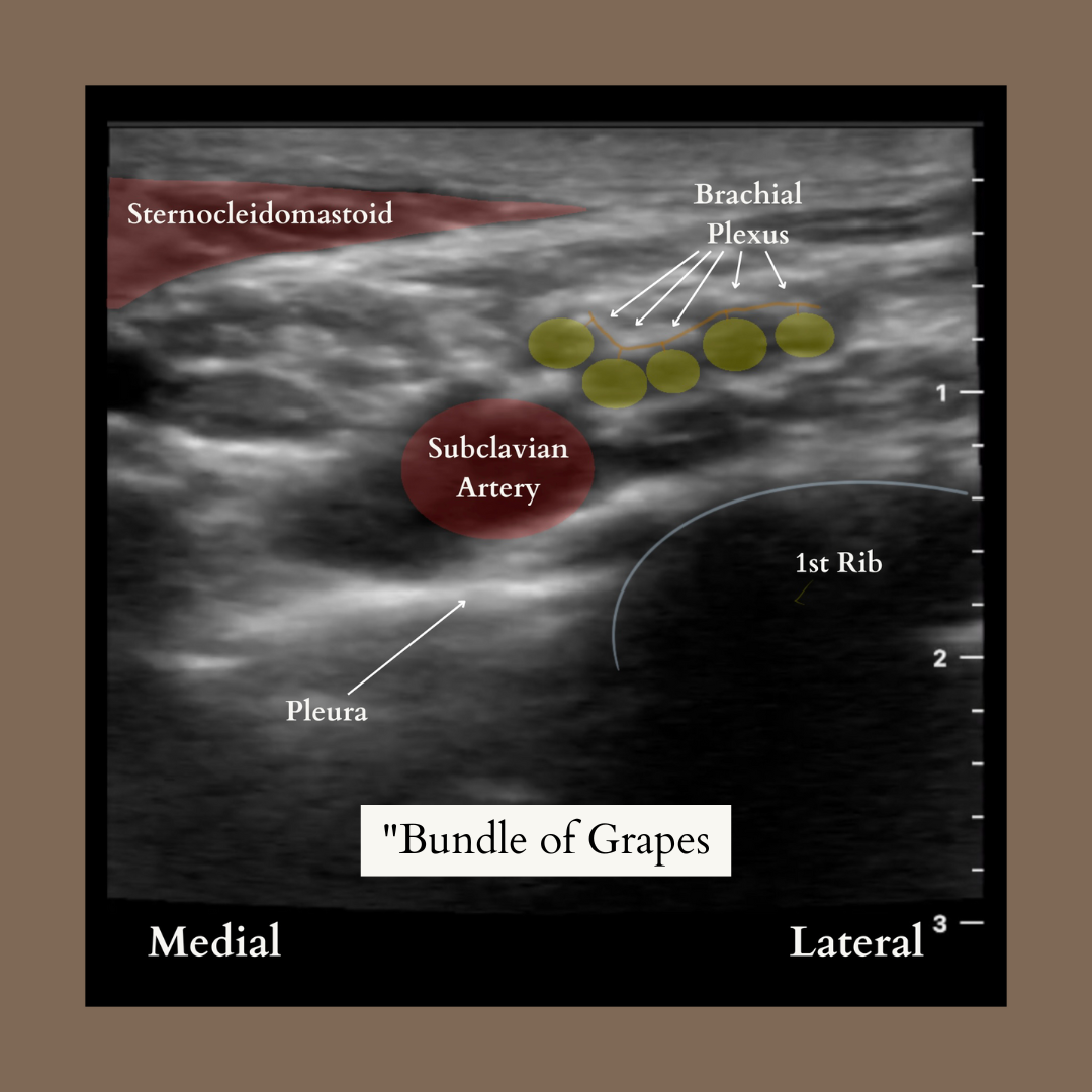 Supraclavicular Nerve Block