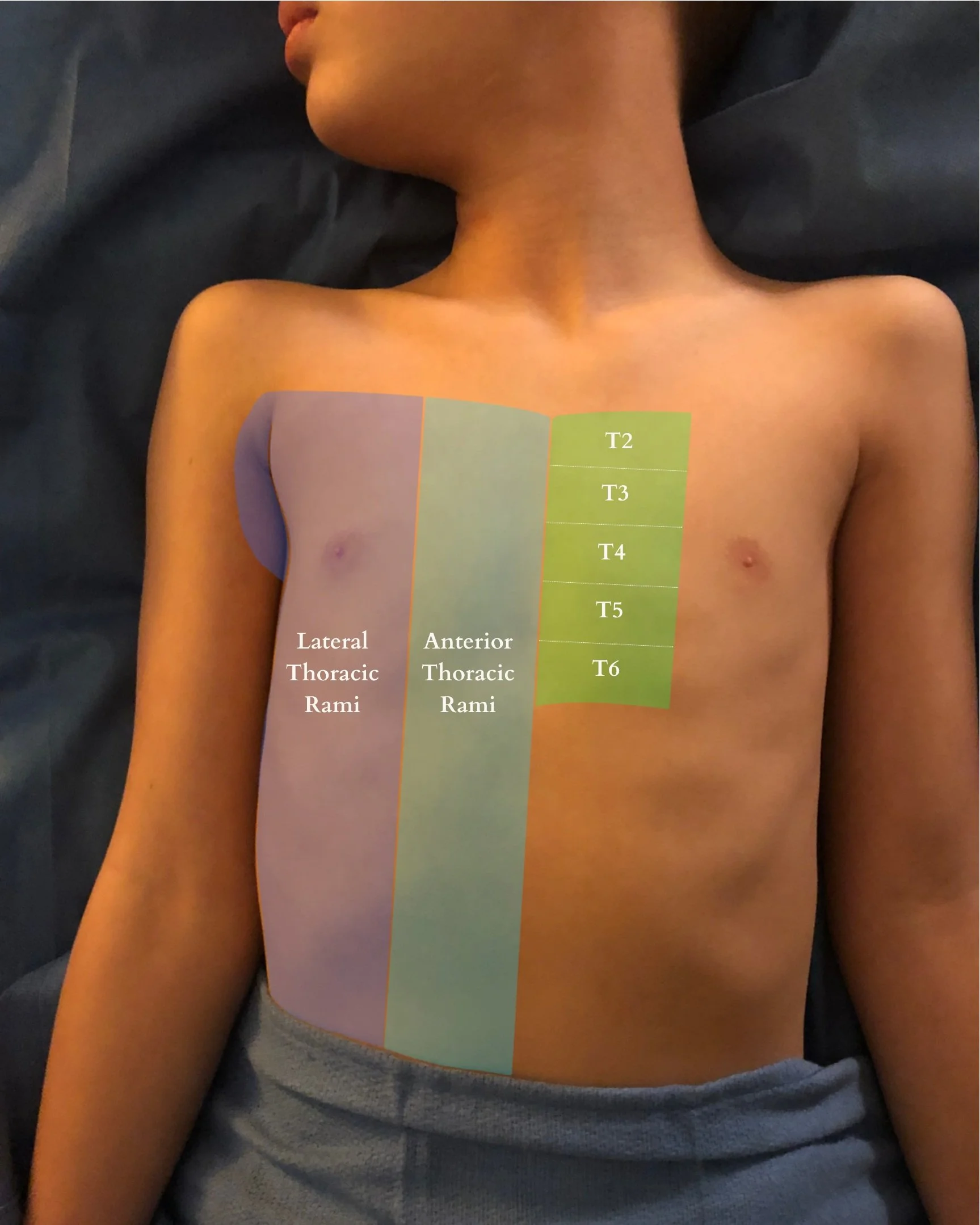 Deep Parasternal Intercostal Plane Block — BABY BLOCKS