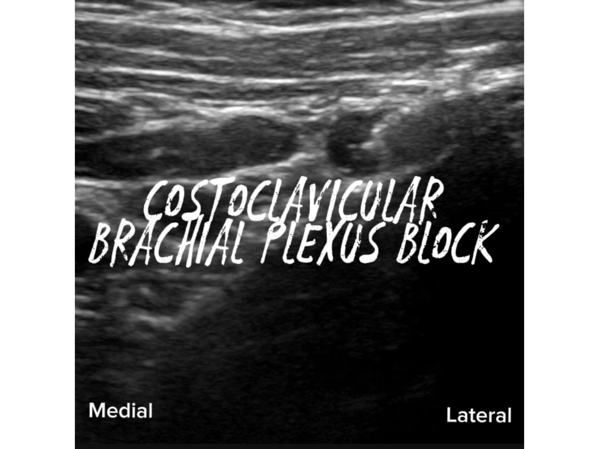 Costoclavicular Brachial Plexus Block — BABY BLOCKS