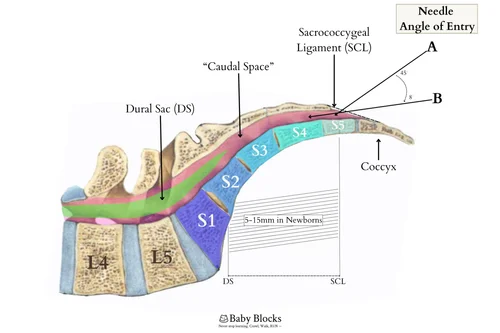 Caudal Block in Children: Indications, Anatomy, Technique, Dosing, and ...