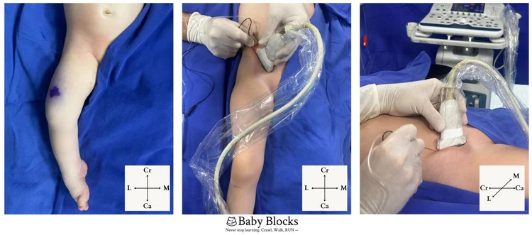 PENG Block: Ultrasound-Guided Hip Analgesia — BABY BLOCKS