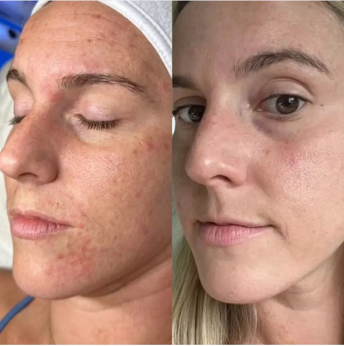 Hydrinity Restorative Post Procedure Kit — Bene Skin & Laser