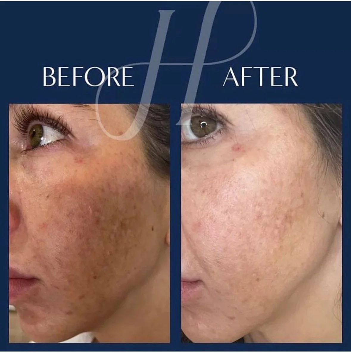 Hydrinity Vivid Brightening Serum - 1 fl oz — Bene Skin & Laser