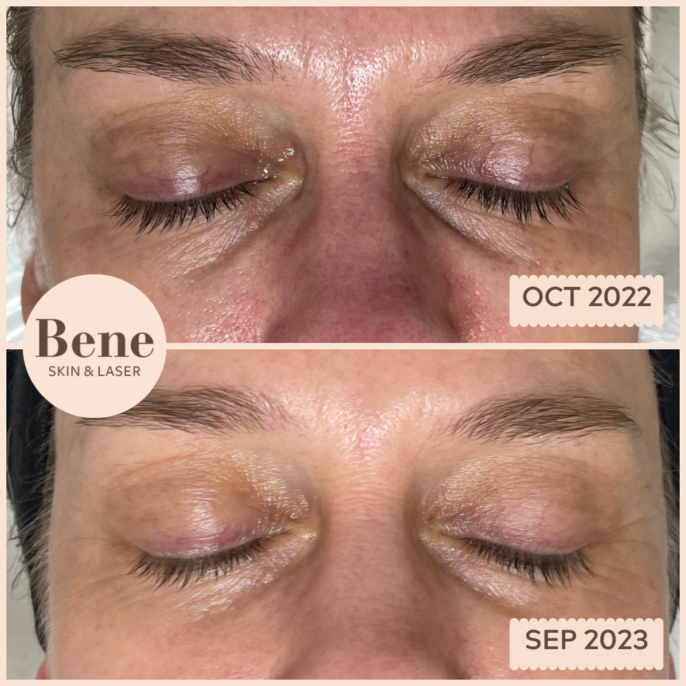 Chemical Peels | Austin, TX — Bene Skin & Laser