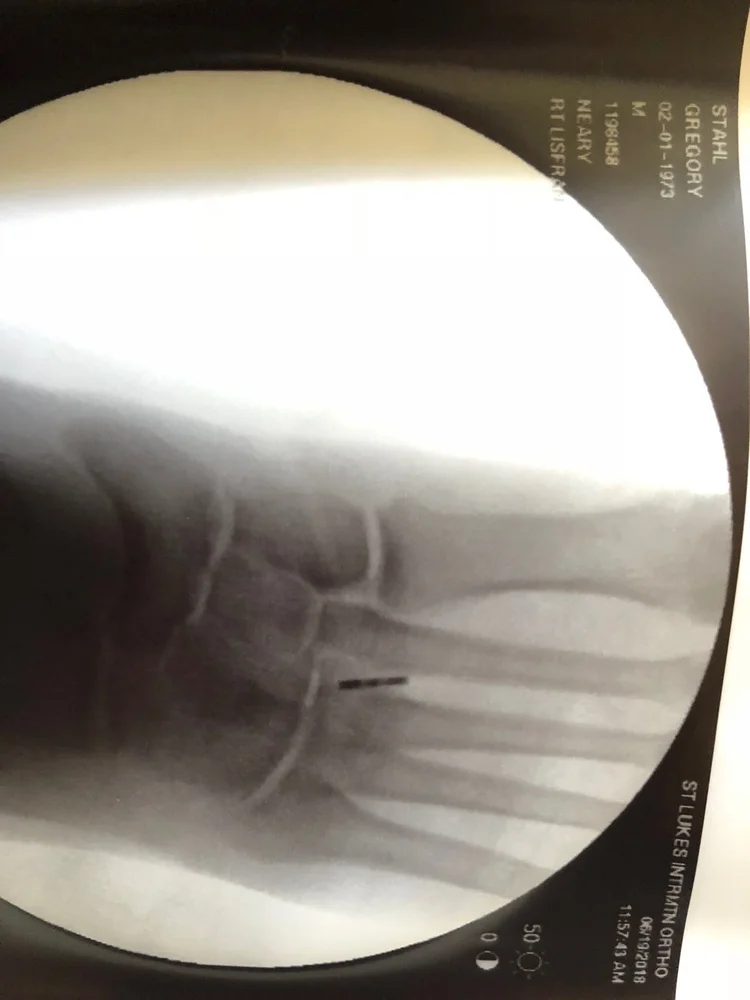 Can the Arthrex Internal Brace fix a Lisfranc fracture? — Tackle Tough ...