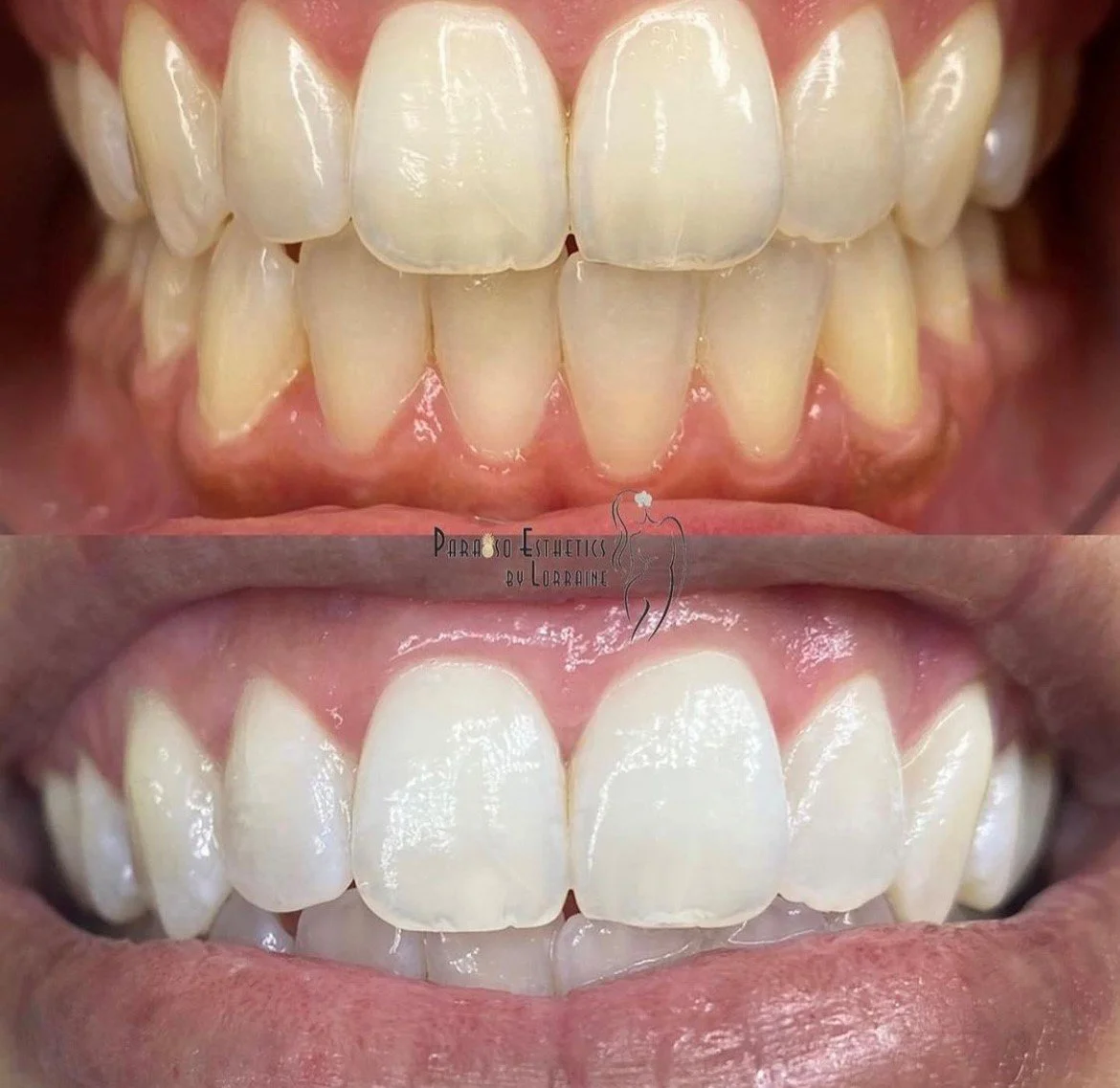 Pro-Teeth Whitening Products