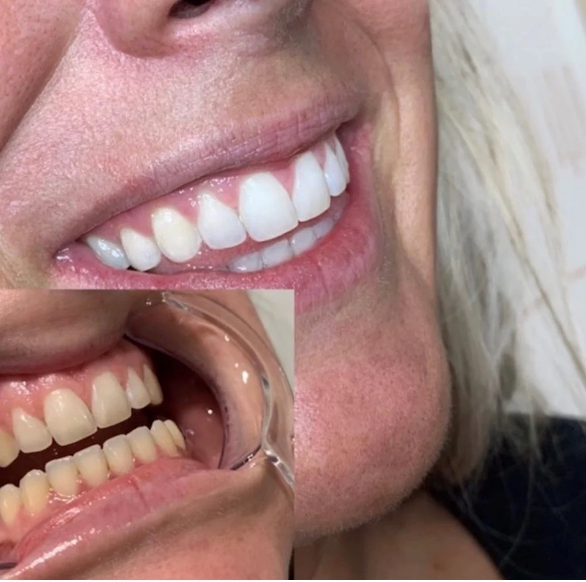 Pro-Teeth Whitening Products