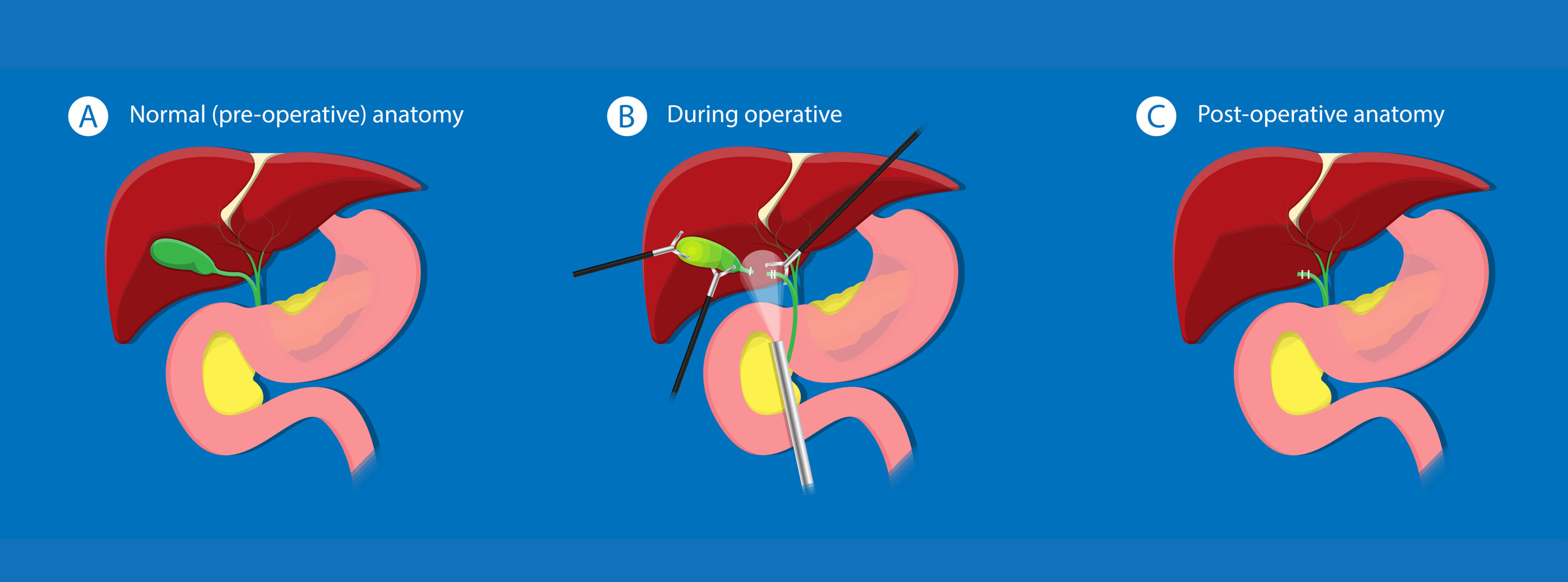 Cholecystectomy Hepatobiliary Upper Gastrointestinal Surgery Cholecystectomy Hepatobiliary Upper Gastrointestinal Surgery