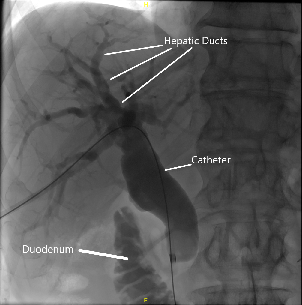 PTC — Hepatobiliary & Upper Gastrointestinal Surgery
