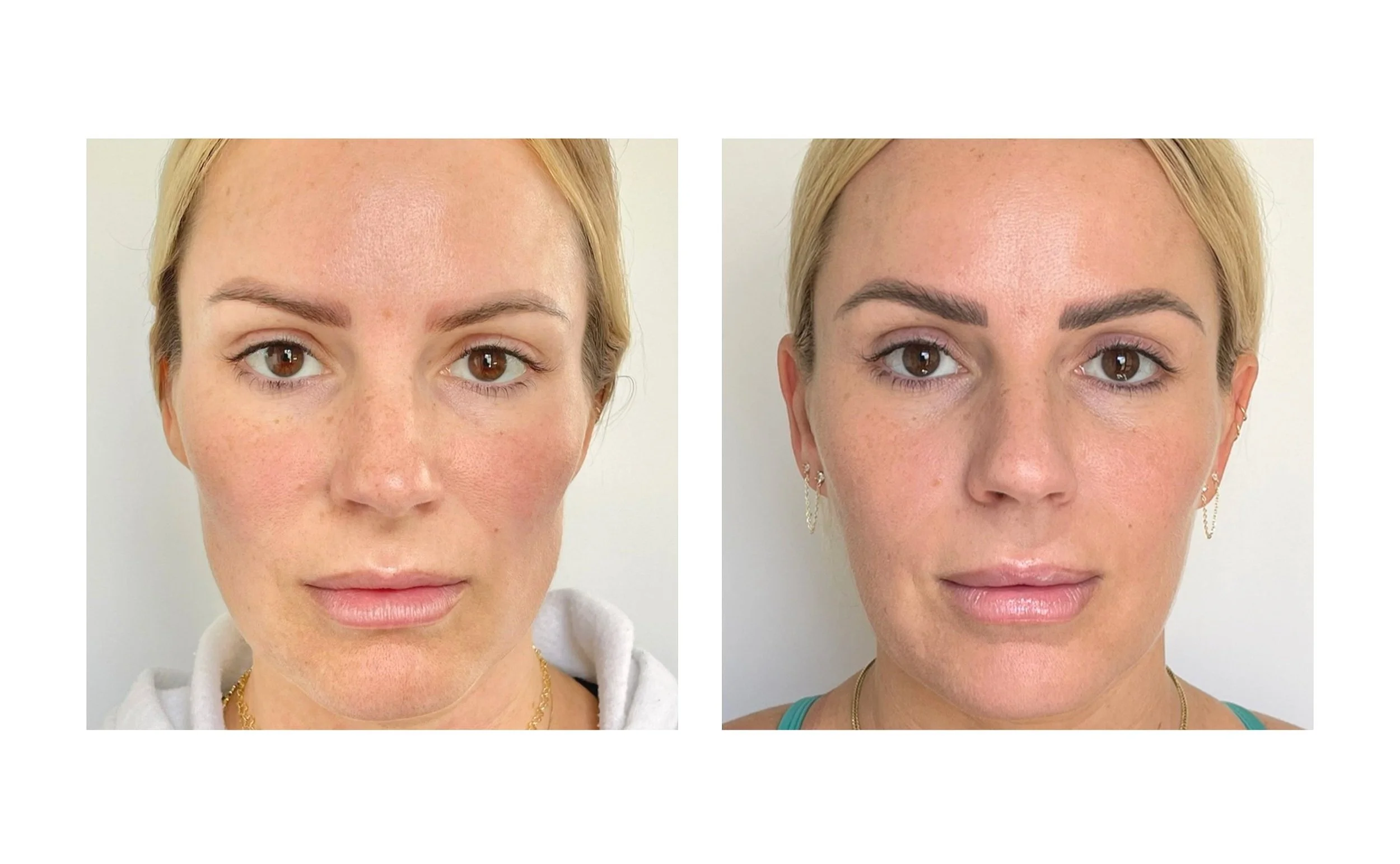 Dermal Fillers — EverGlow Aesthetics