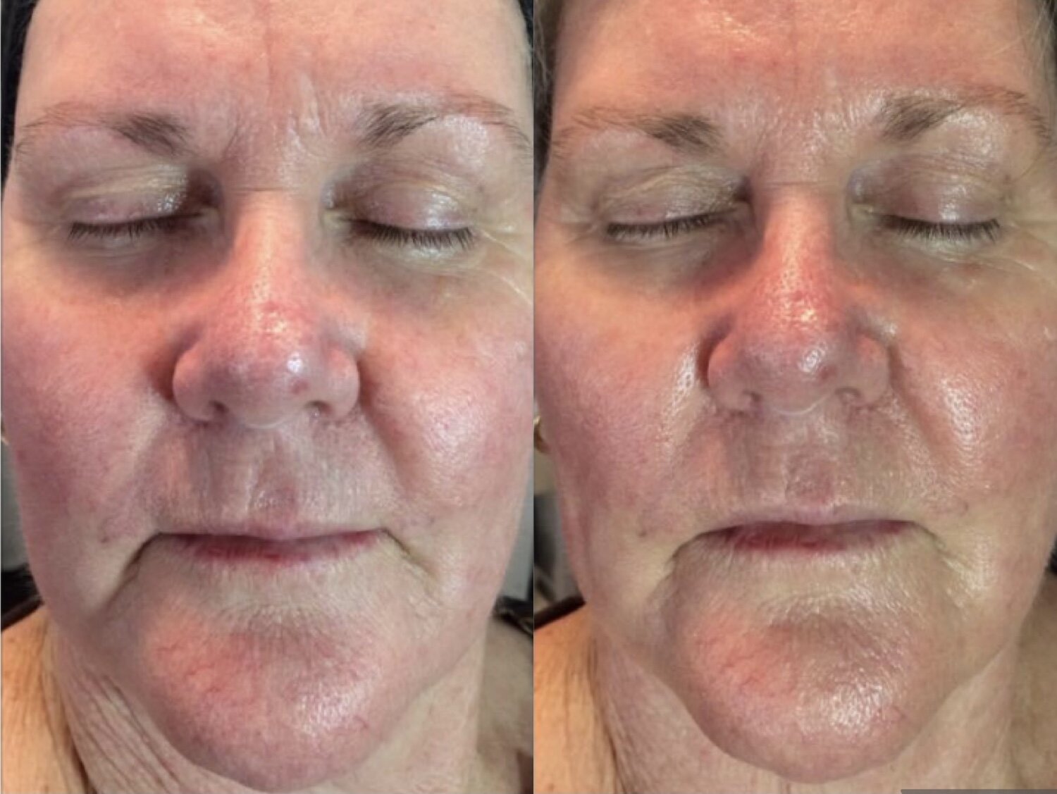 Microcurrent Sculpting — KITTY KAT SKIN & BEAUTY