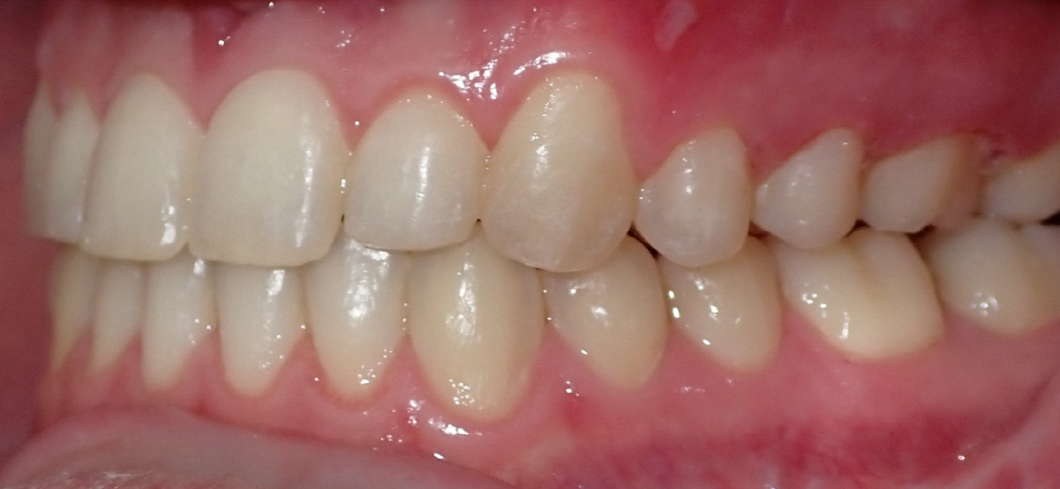 Monitoring Lower Jaw Growth — Meyer Orthodontics