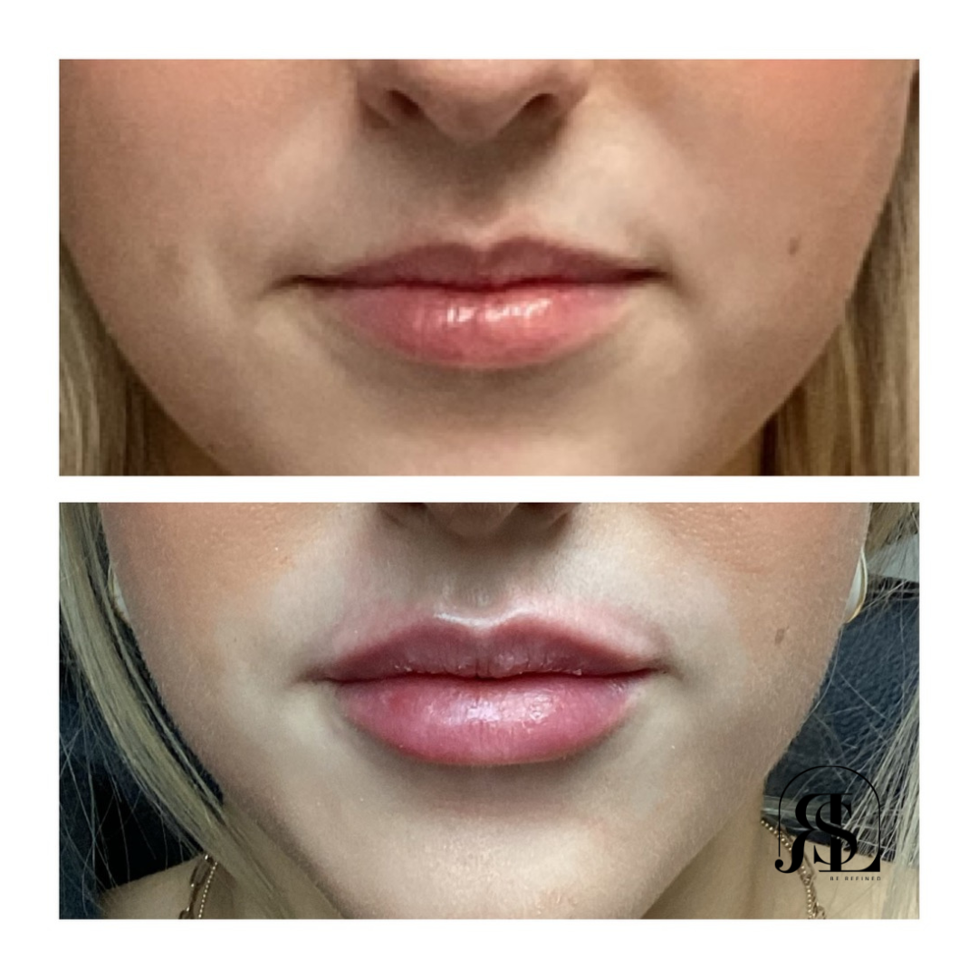 Lip Filler Before and After: What’s the Difference? — Refine Laser ...